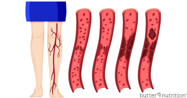12 Signs of Hypercoagulation (thick, sticky blood that is prone to ...